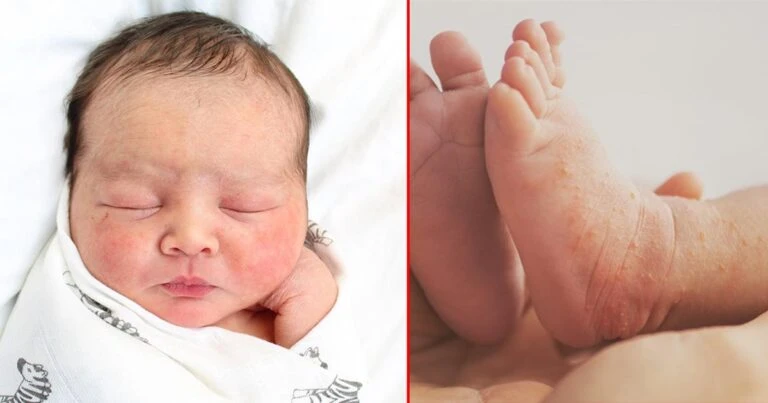 Bebeklerde isilik nasıl geçer? İsiliği geçirecek krem önerileri » Mavi ...