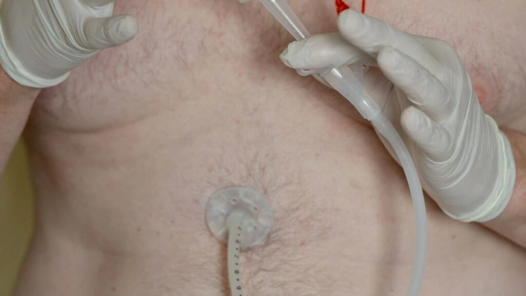 PEG çıkarsa ne olur, neden çıkar? PEG yerinden çıkınca ne yapılır ...